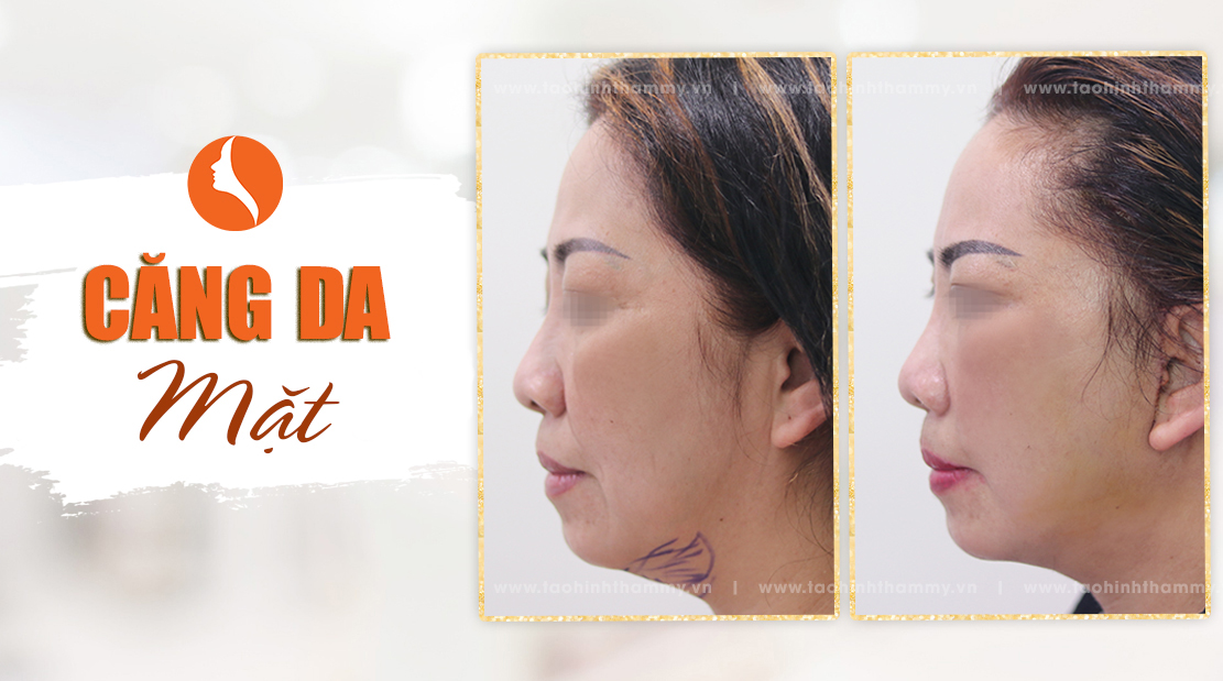 Phẫu thuật Căng da Mặt | Bác sĩ Nhân